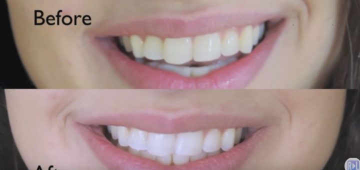 Indian Boy Ashik Gavai Has Record 232 Teeth Removed – The Tooth